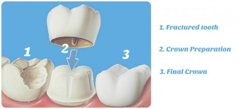 Everything you need to know about Dental Jacket - #1 DENTIST IN ...